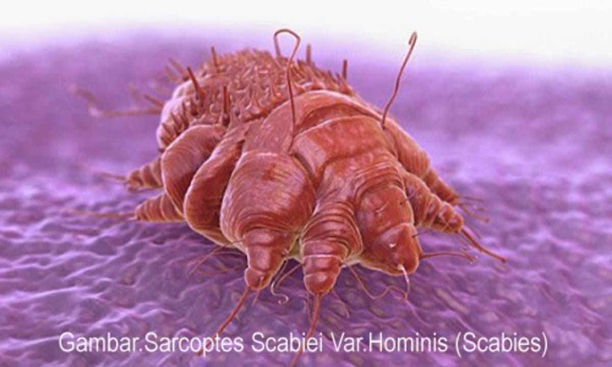 5 Cara Membunuh Kutu Scabies dan Telurnya dengan Mudah